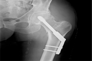 How Does Fractured Hip Treatment Undergo?