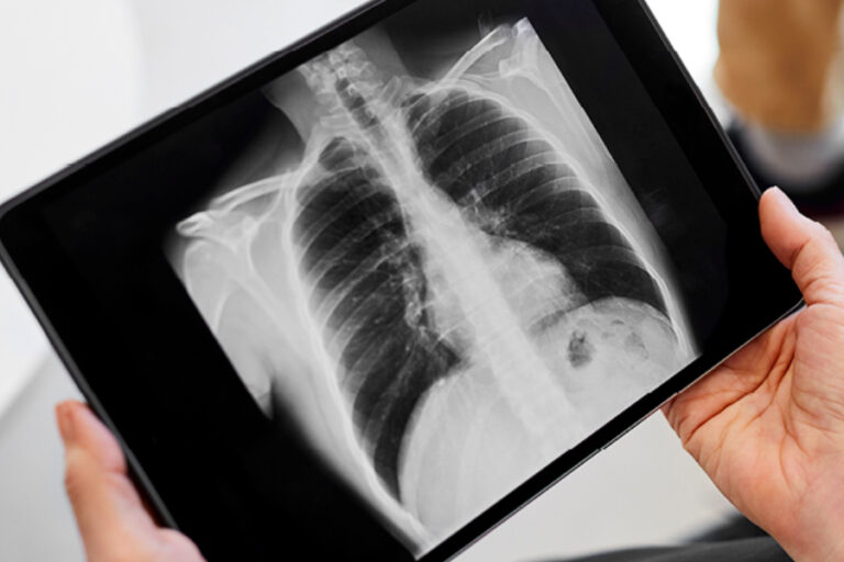 Lung Cancer in Men
